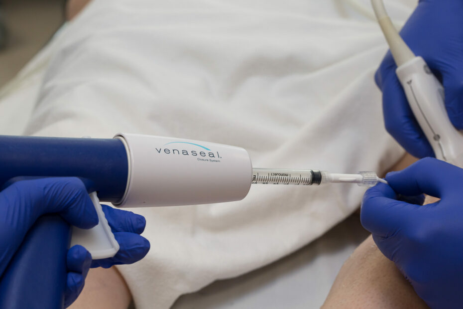 Sclerotherapy or Venaseal® or both for my varicose veins?